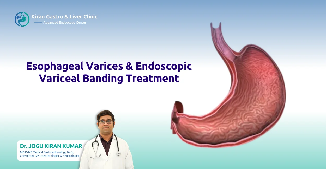 Esophageal Varices Diagnosis & Treatment in Hyderabad | Dr. Kiran Kumar ...